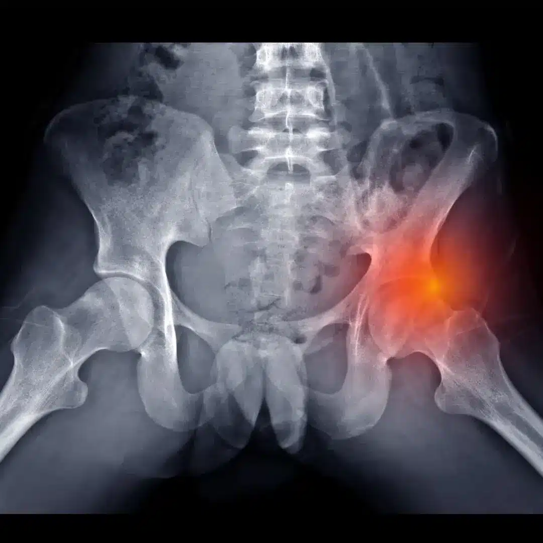 Piriformis Syndrome Treatment And Relief Tensegrity